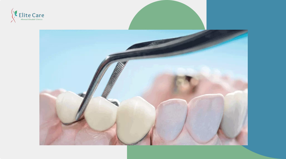 Prosthodontics & periodontal treatment - Dr-Ahmed-Elnabil